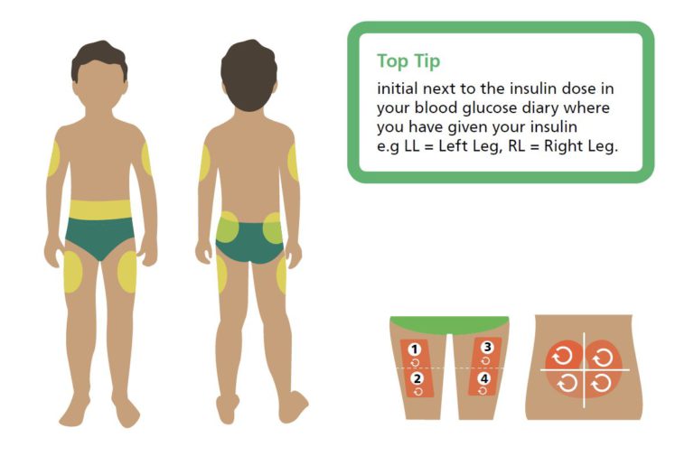 Bolus Insulin in Type 1 Diabetes — Key Guide | GNL